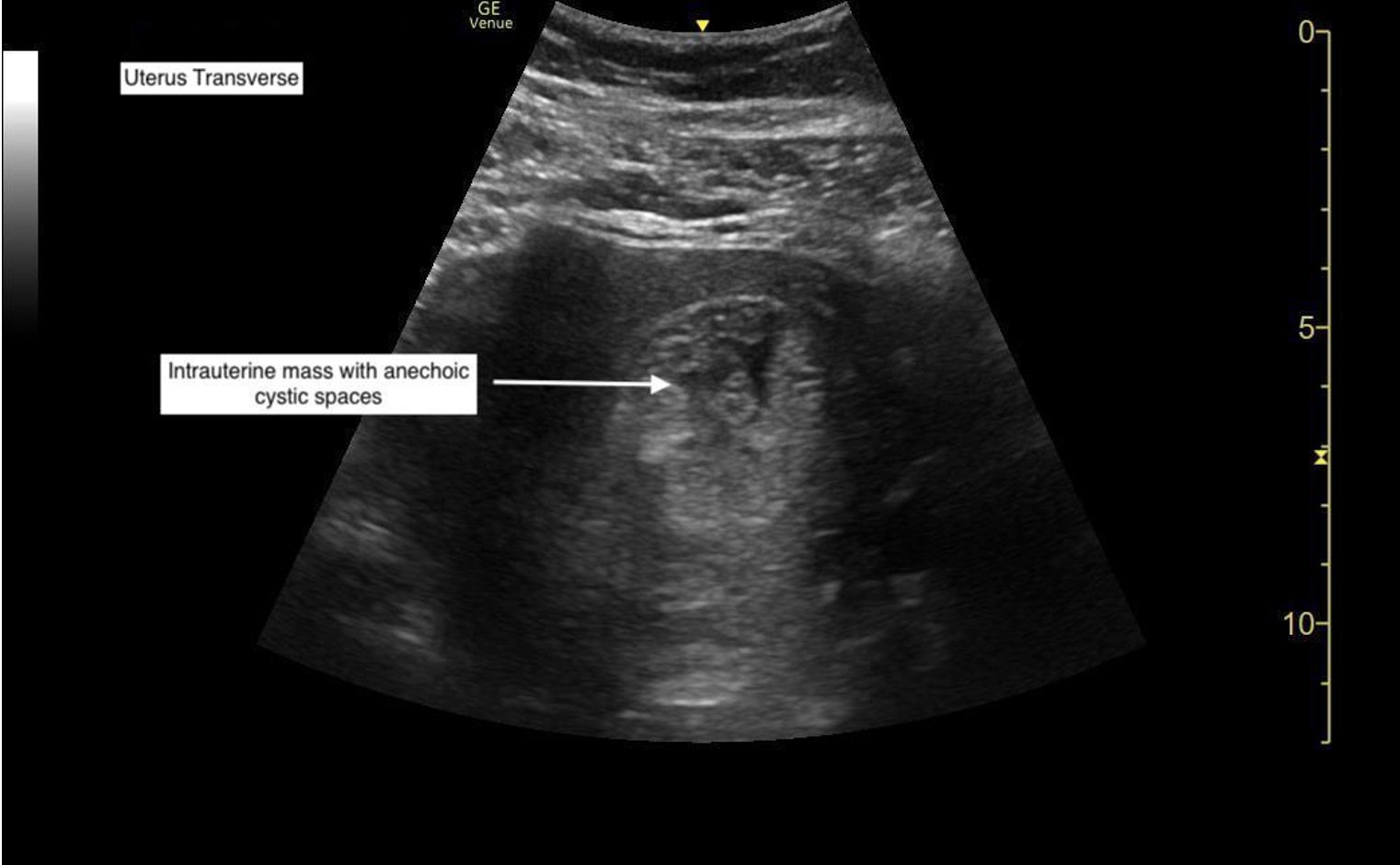 Point-of-Care Ultrasound to Diagnose Molar Pregnancy. A Case Report. US ...